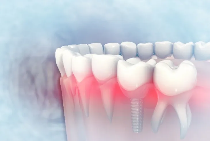 The Ripple Effect of Missing Teeth: Why Implants May Be Your Best Bet ...